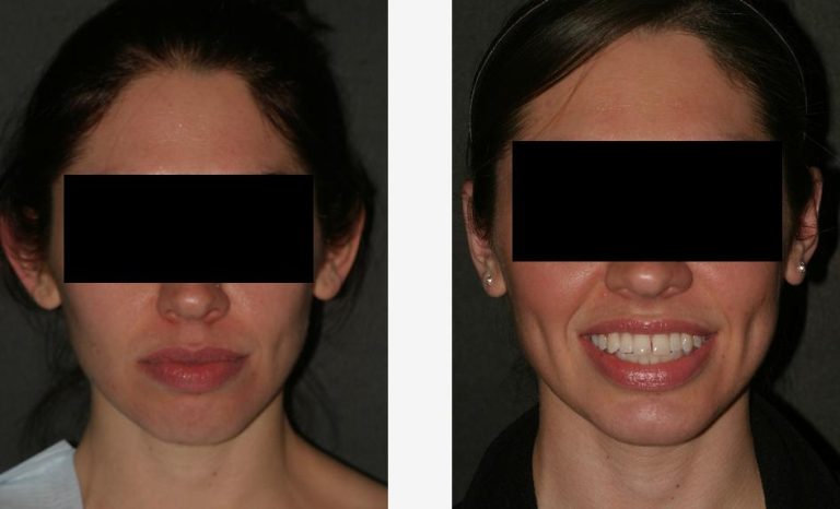 Facial Implants - Dr. Sourabh Rawat