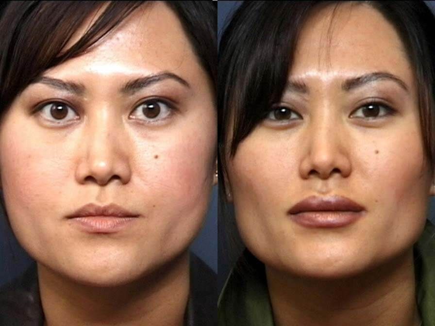 Cheek Augmentation - Dr. Sourabh Rawat