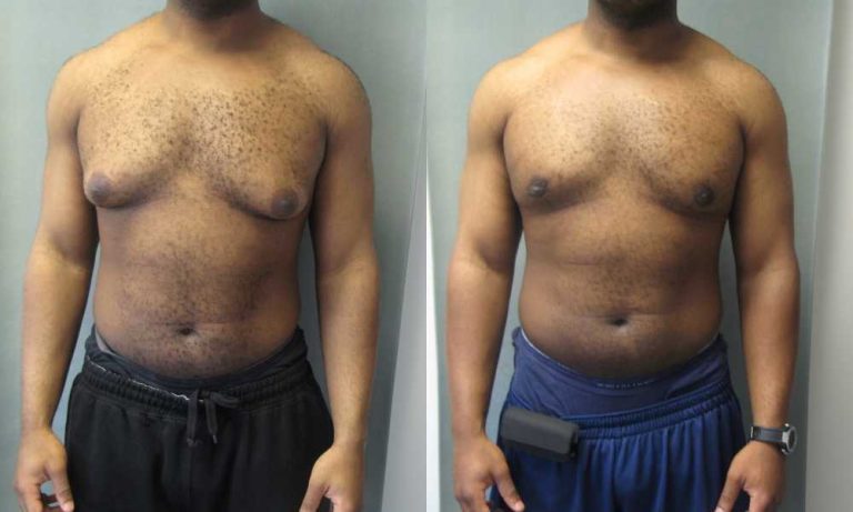 Gynecomastia Surgery - Dr. Sourabh Rawat