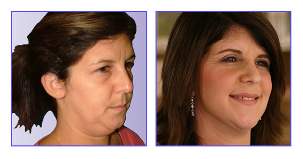 Neck Lift - Dr. Sourabh Rawat